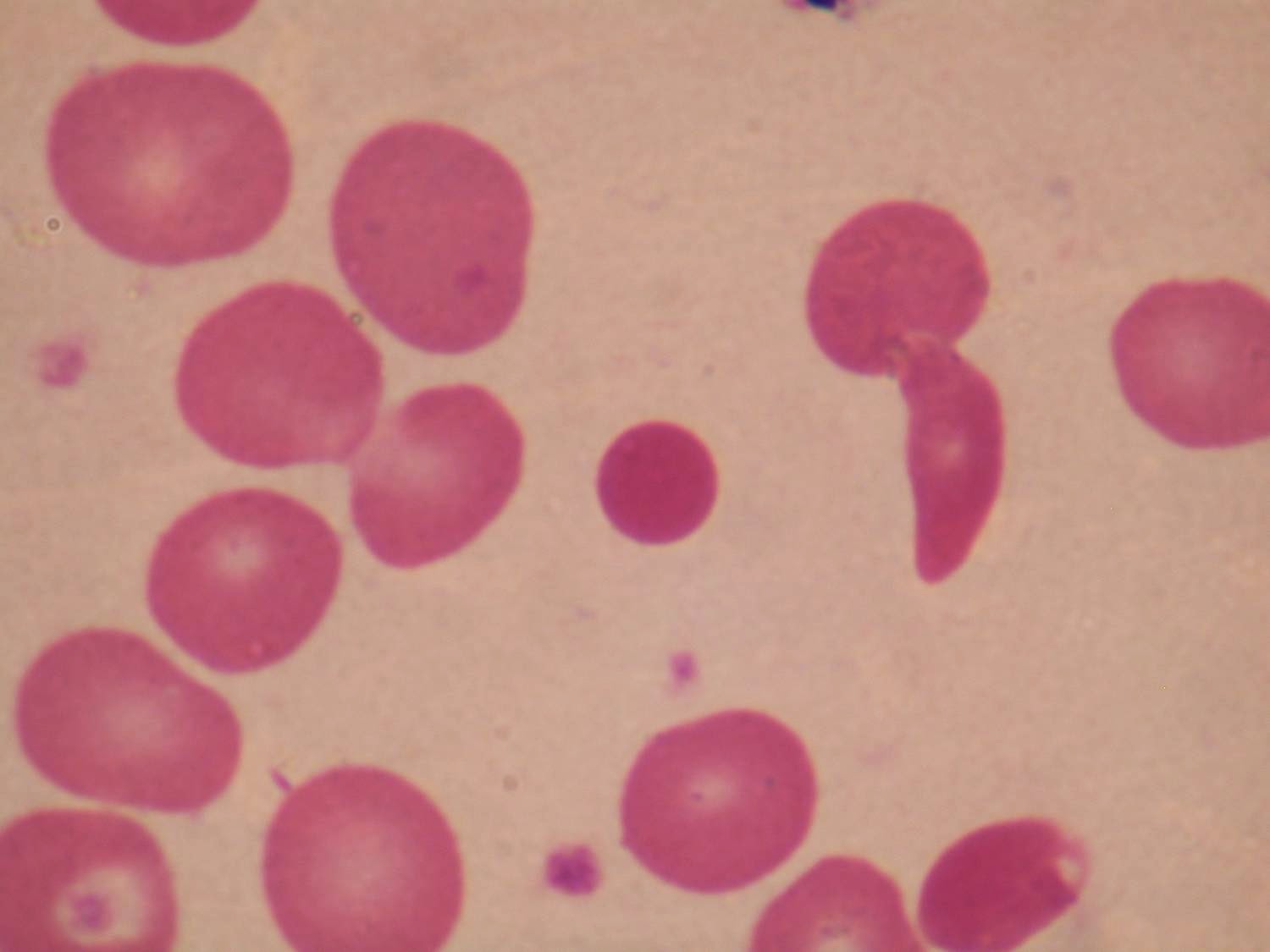 PRACTICAHEMATM: TM 26 Actividad Drama #3 Biometria Hematica Completa (BHC)