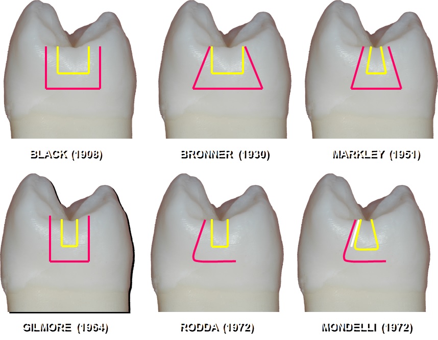 Saúde da Boca: Preparo Cavitários- CAVIDADES CLASSE I e II PARA AMÁLGAMA