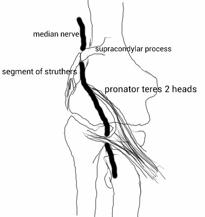 MEDIAN NERVE COMPRESSION - DNB Orthopaedics MS Orthopedics MRCS Exam ...