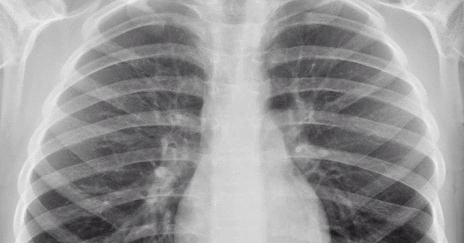 Diarios de Radiologia: Costillas Bífidas
