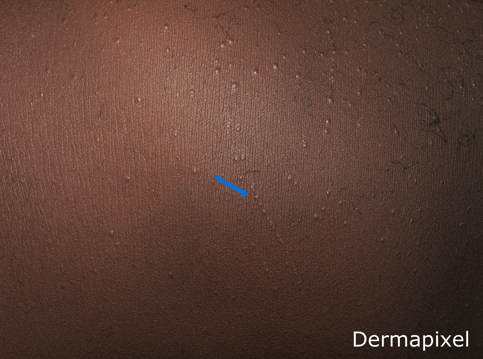 Dermapixel: noviembre 2017