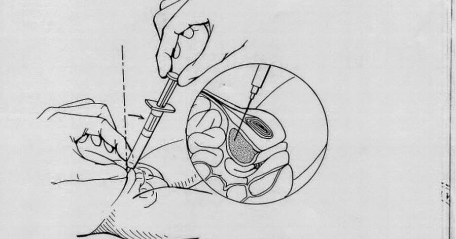 Medical & Beyond: SUPRAPUBIC BLADDER TAP