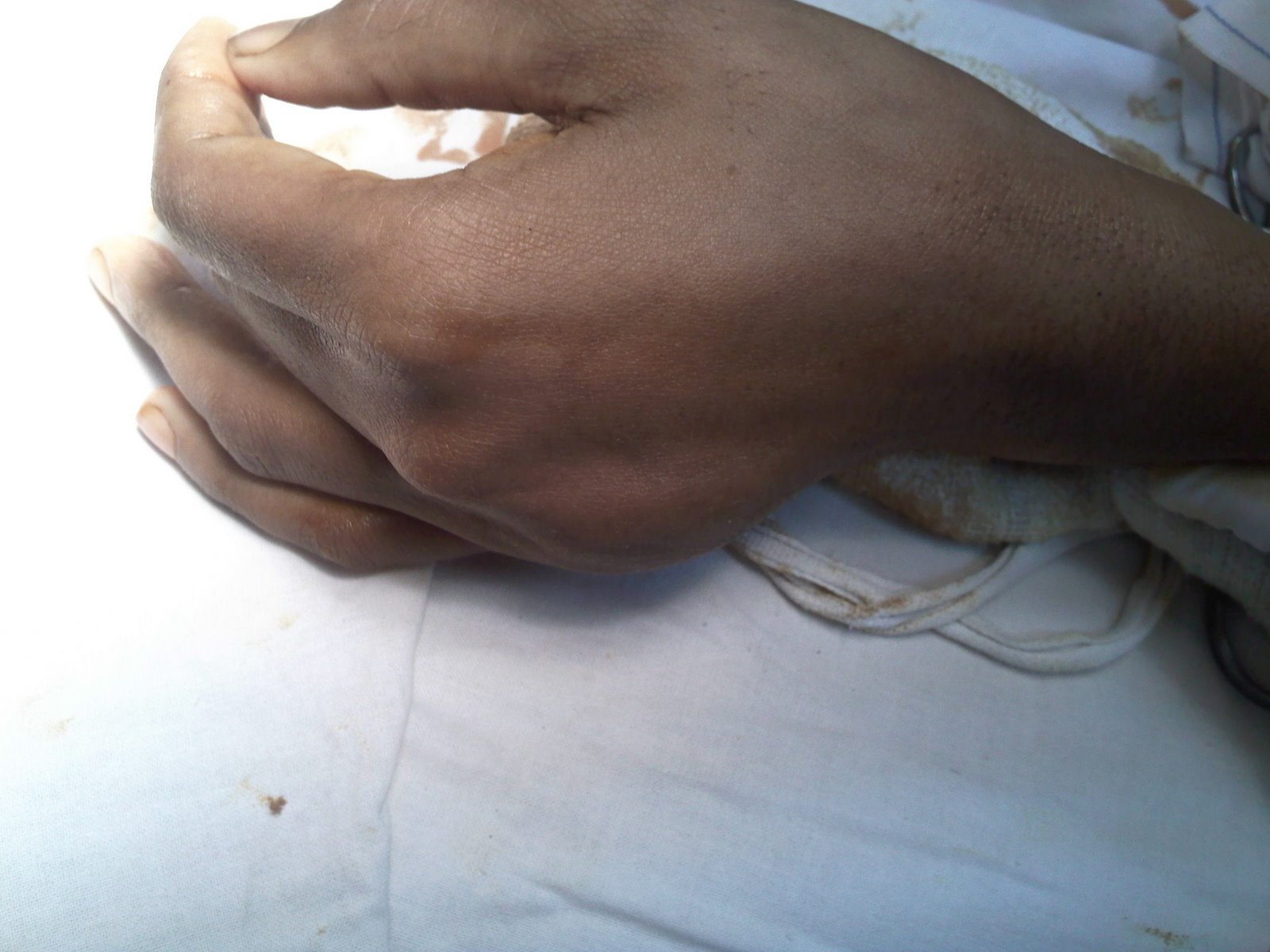 Clinical images: Clinical picture of the hand with tumor