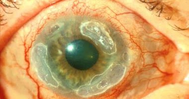 Penyakit Ulkus Kornea, Apakah Itu? - Hotcopas