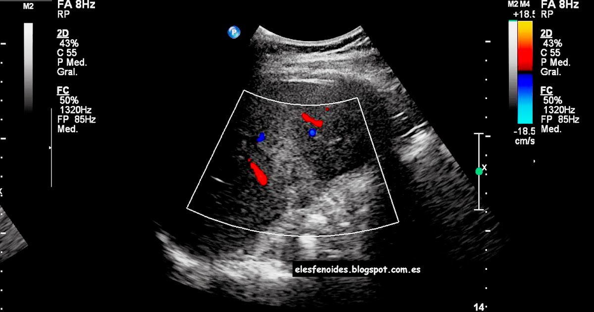 El esfenoides: Laceración hepática. 2 imágenes 1 caso.
