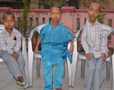 progeria cases in india ~ Christine O'Donnell