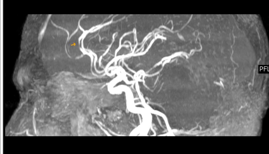 Corpus Callosum Infarction-MRI - Sumer's Radiology Blog