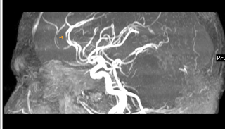 Corpus Callosum Infarction-MRI - Sumer's Radiology Blog