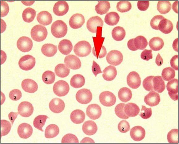 silviaquerida: Kelainan Sediaan Apus Darah