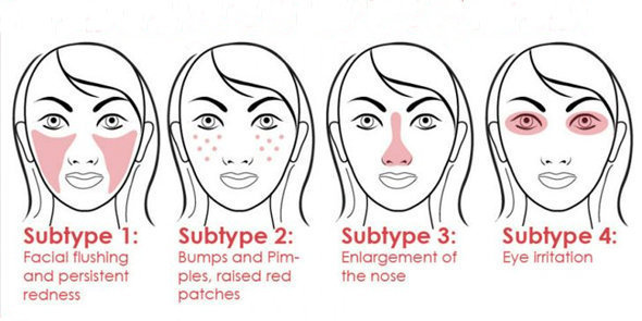 Scarlet Letters, dealing with vascular rosacea, face flushing, burning ...