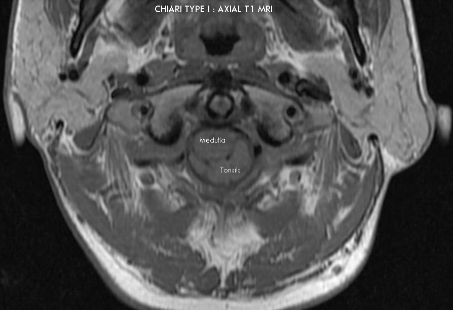 Ultimate Radiology : The Chiari I Malformation