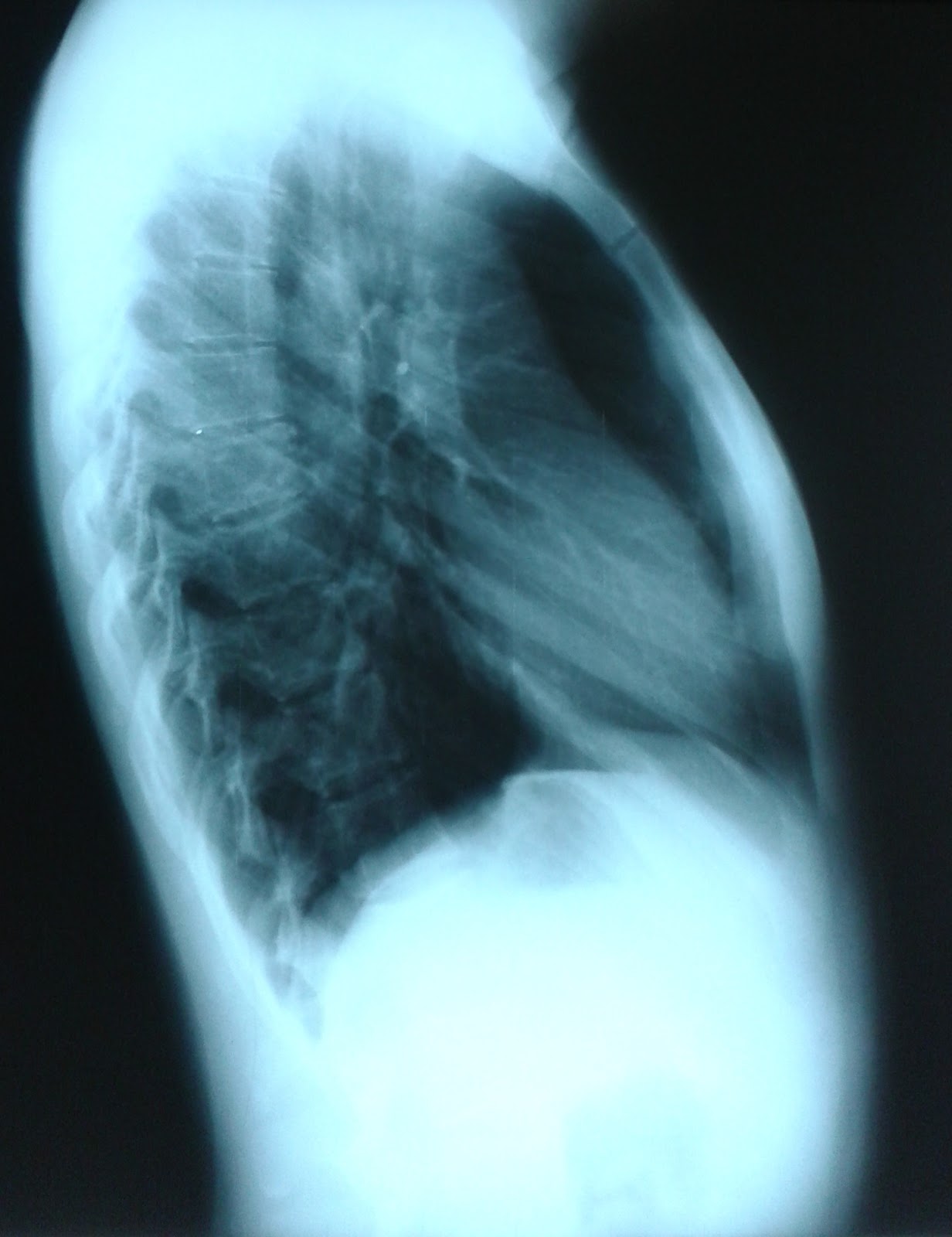 DICAS DE RADIOLOGIA: TÉCNICAS RADIOLÓGICAS - POSICIONAMENTO RX DO TÓRAX ...