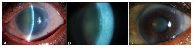 Journal and Conferences on Ophthalmology: Corneal Toxicity after Self ...