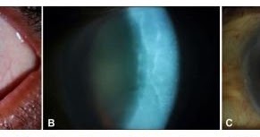 Journal and Conferences on Ophthalmology: Corneal Toxicity after Self ...