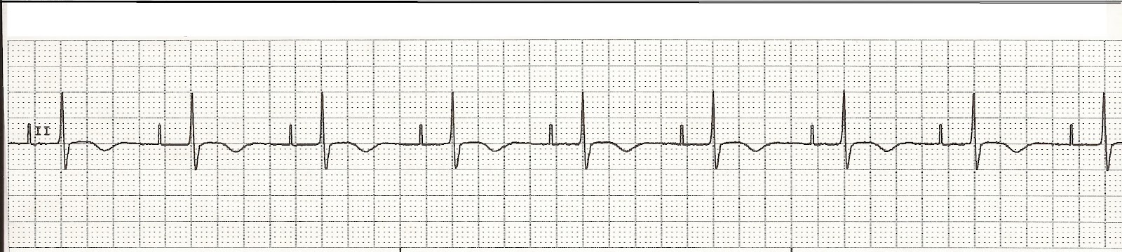 EKG Rhythm Strips 50