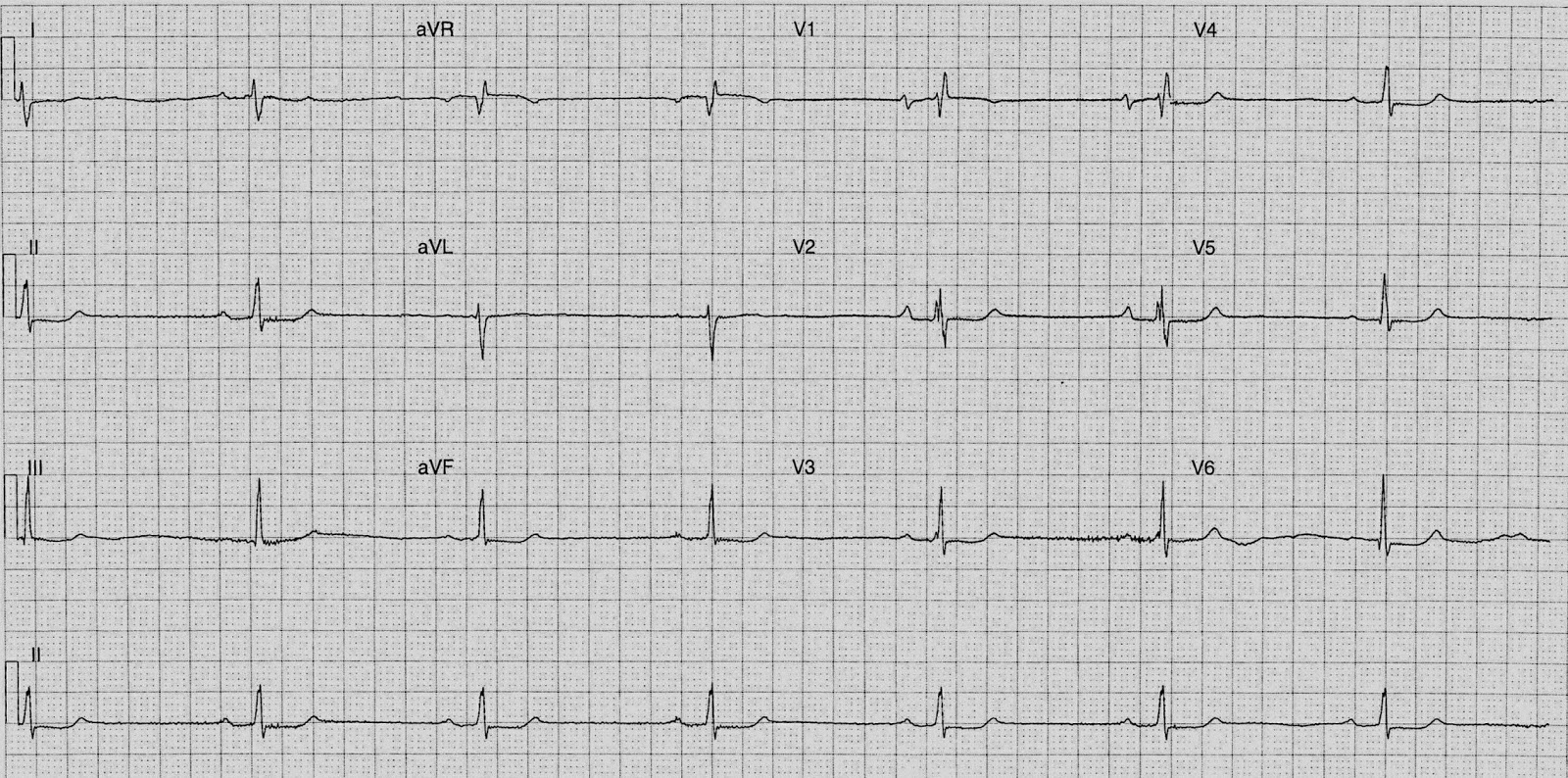 ECG of the Week: ECG of the Week - 30th September 2013 - Interpretation