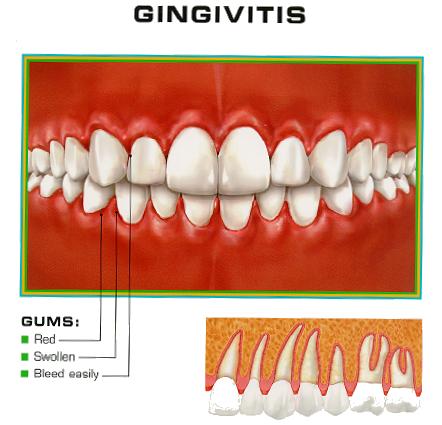 OROSALUD Clínicas Odontológicas: Gingivitis: Signos y Síntomas