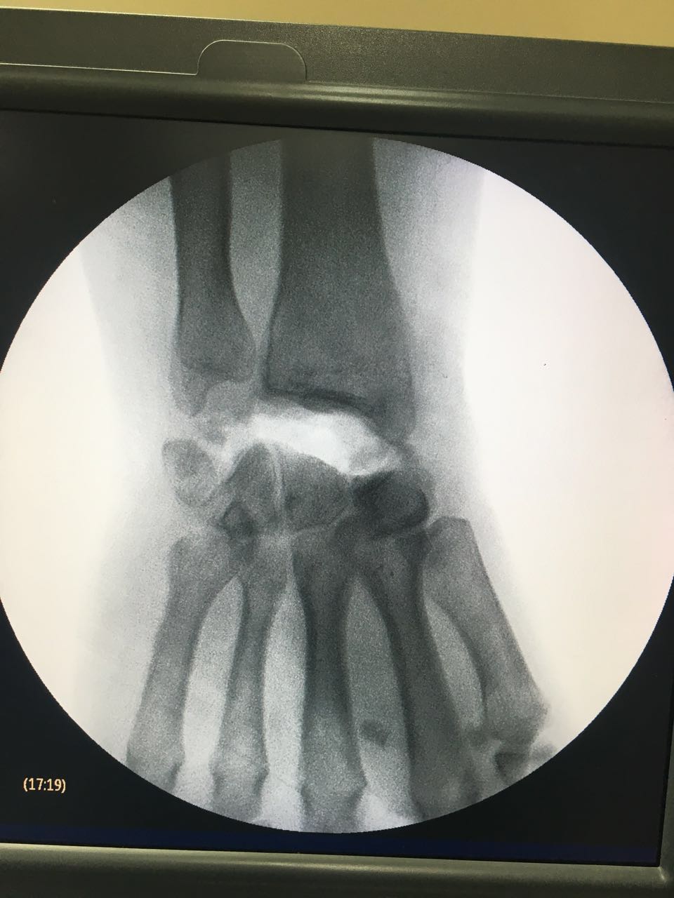 proximal row carpectomy