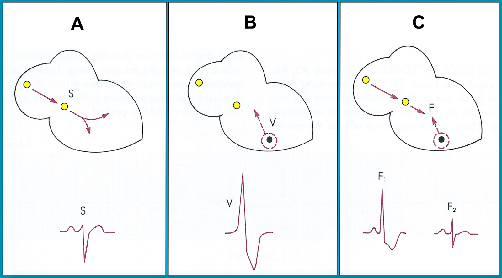 ECG Interpretation: ECG Blog #128 — VT, Fusion, WCT, Sinus Tach