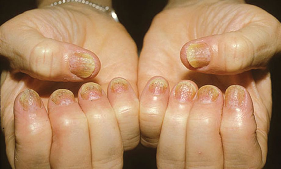 TIP-TIP KESIHATAN - BLOG YANG PATUT DIBACA: TOMPOK MERAH SISIK TEBAL