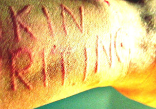 Dermatographic Urticaria - Dermatographic Urticaria Cure