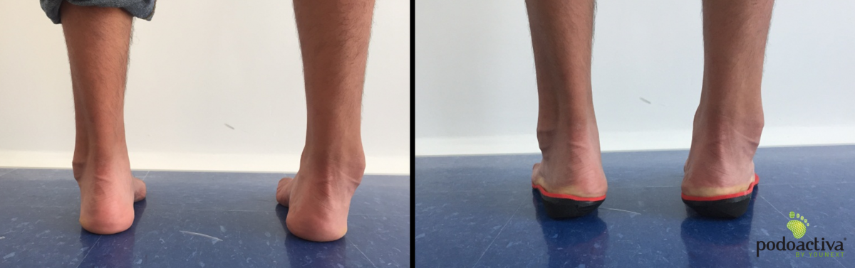 PERSONAS CON CHARCOT MARIE TOOTH: COMO AFECTA EN LA PISADA