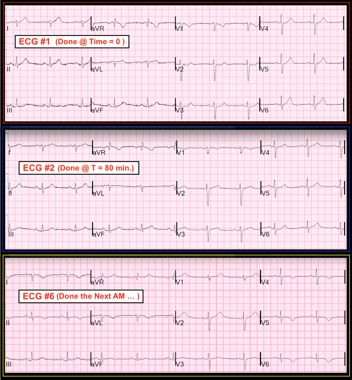 Dr. Smith's ECG Blog: A completely healthy 30-something woman with ...