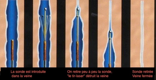 Clinique des Varices France: Laser endoveineux (laser des varices ...