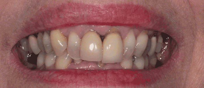 Milford Dentists Blog: Cost Of Dental Crown
