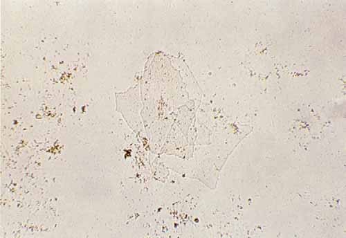 Atlas of Crystals found in alkaline urine | Free Medical Atlas