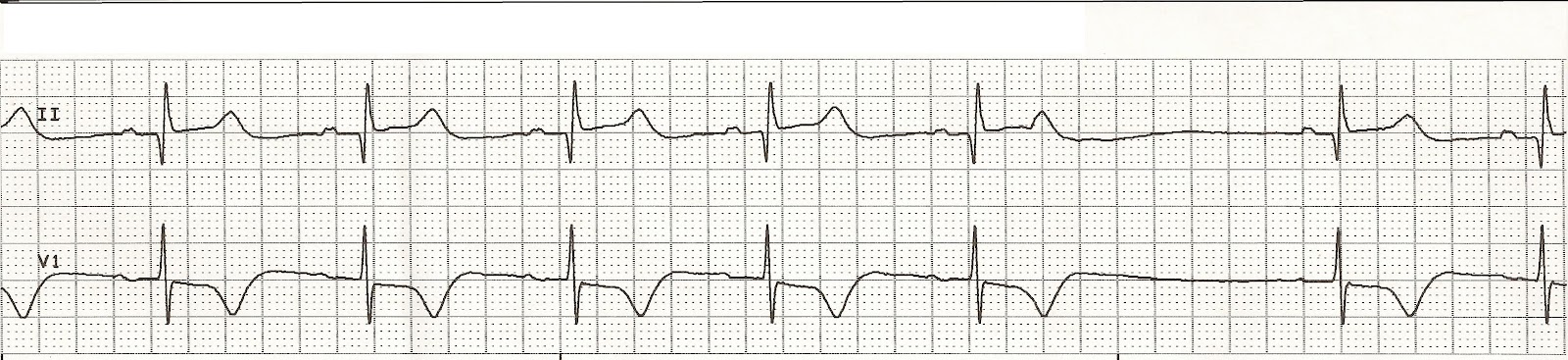 EKG Rhythm Strip Quiz 48