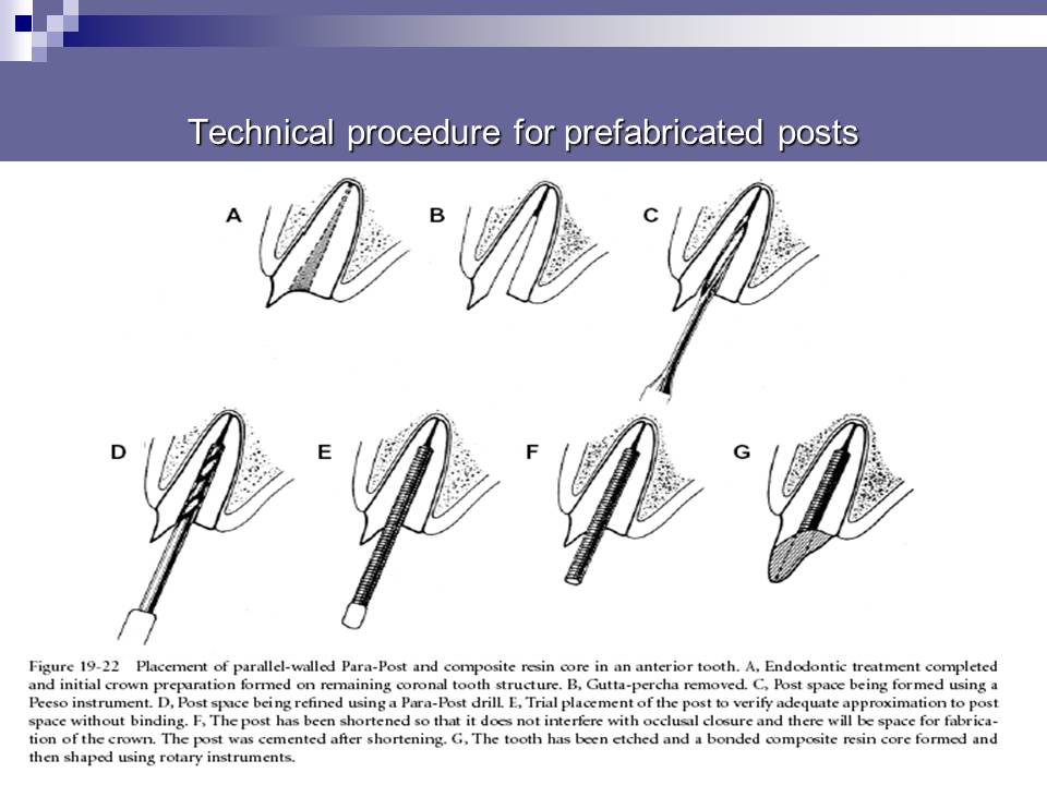 Dentistry: Restoration of Endodontically Treated Teeth