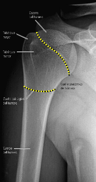 MMSS-RX ARTICULACION ESCAPULOHUMERAL