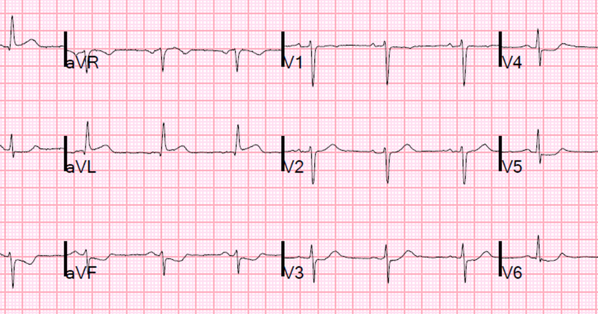 Dr. Smith's ECG Blog: True Positive ST elevation in aVL vs. False ...