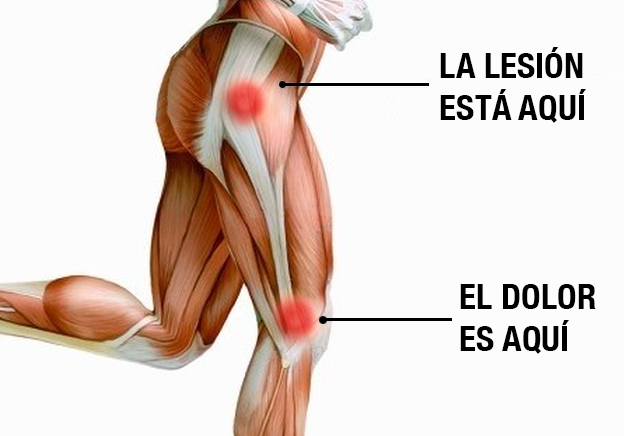 SÍNDROME DE LA CINTILLA ILIOTIBIAL