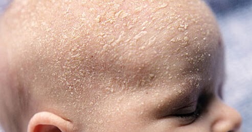 Descamação na cabeça do bebê- caspa, crosta ou casquinha - Blog ...