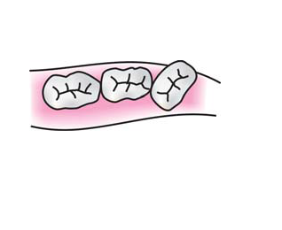 Classification of impacted mandibular third molar