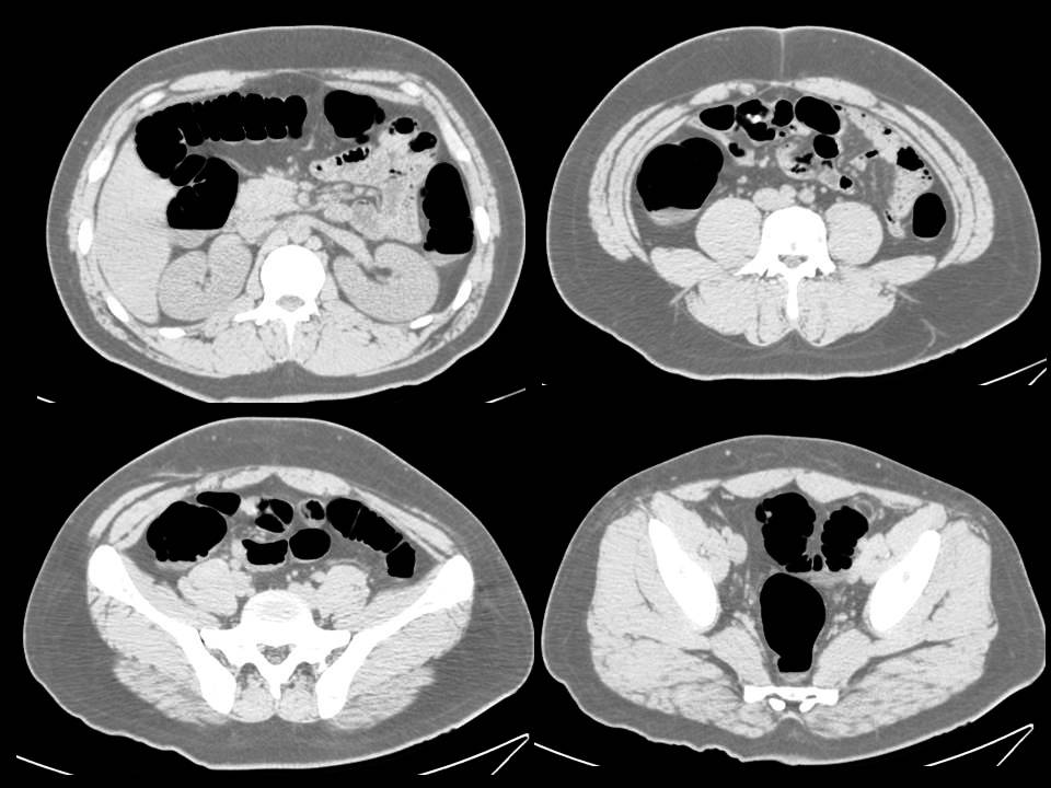 CASIMIRO RADIACTIVO: ESTUDIO DE COLONOSCOPIA VIRTUAL POR TC - VIRTUAL ...