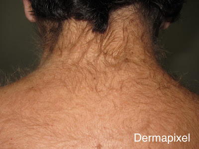 Dermapixel: marzo 2018