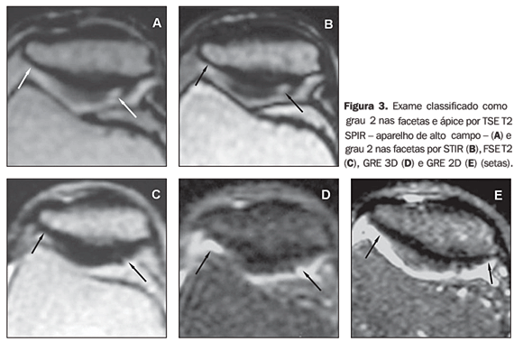 FisioJovem: DOENÇA DE OSGOOD - SCHLATTER E CONDROMALÁCIA PATELAR