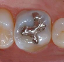 Dentistry and Medicine: Amalgam - Dental Materials Lecture Note