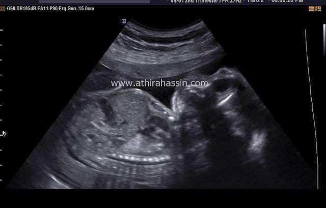 Beza scan baby 2D 3D 4D 5D dan HD - athirahassin