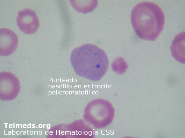 Células Sanguíneas y su patología.: CelulasSanguineasyPatologias