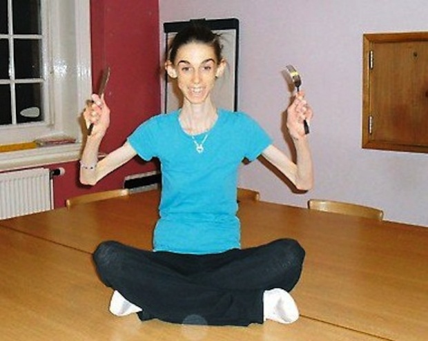 NOTICIAS IMPACTANTES DEL MUNDO: Fallece mujer con peor caso de anorexia