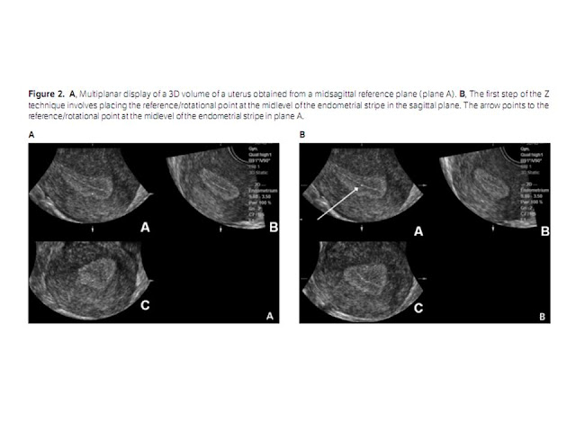 BÀI SOẠN VỀ SIÊU ÂM CHẨN ĐOÁN: 3D US for Uterine Anomalies: The Z Technique