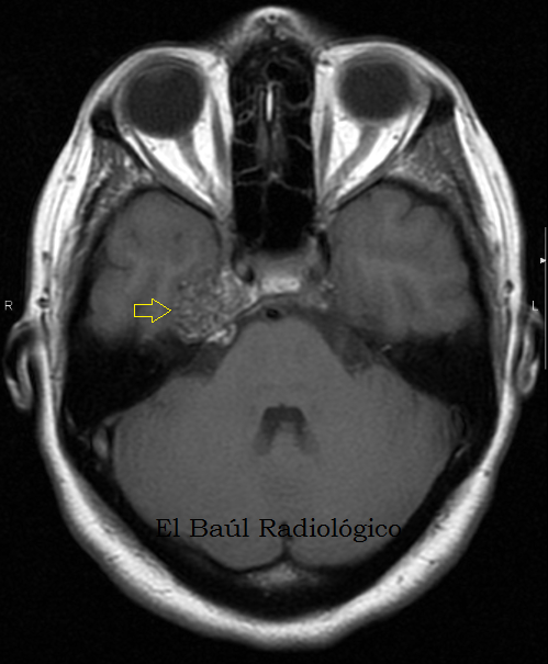 El Baúl Radiológico: 2) QUISTE DERMOIDE INTRACRANEAL (Intracranial ...