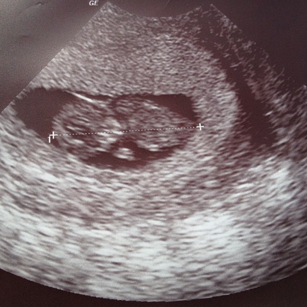 11 week baby update + photo! - Kendall Rayburn