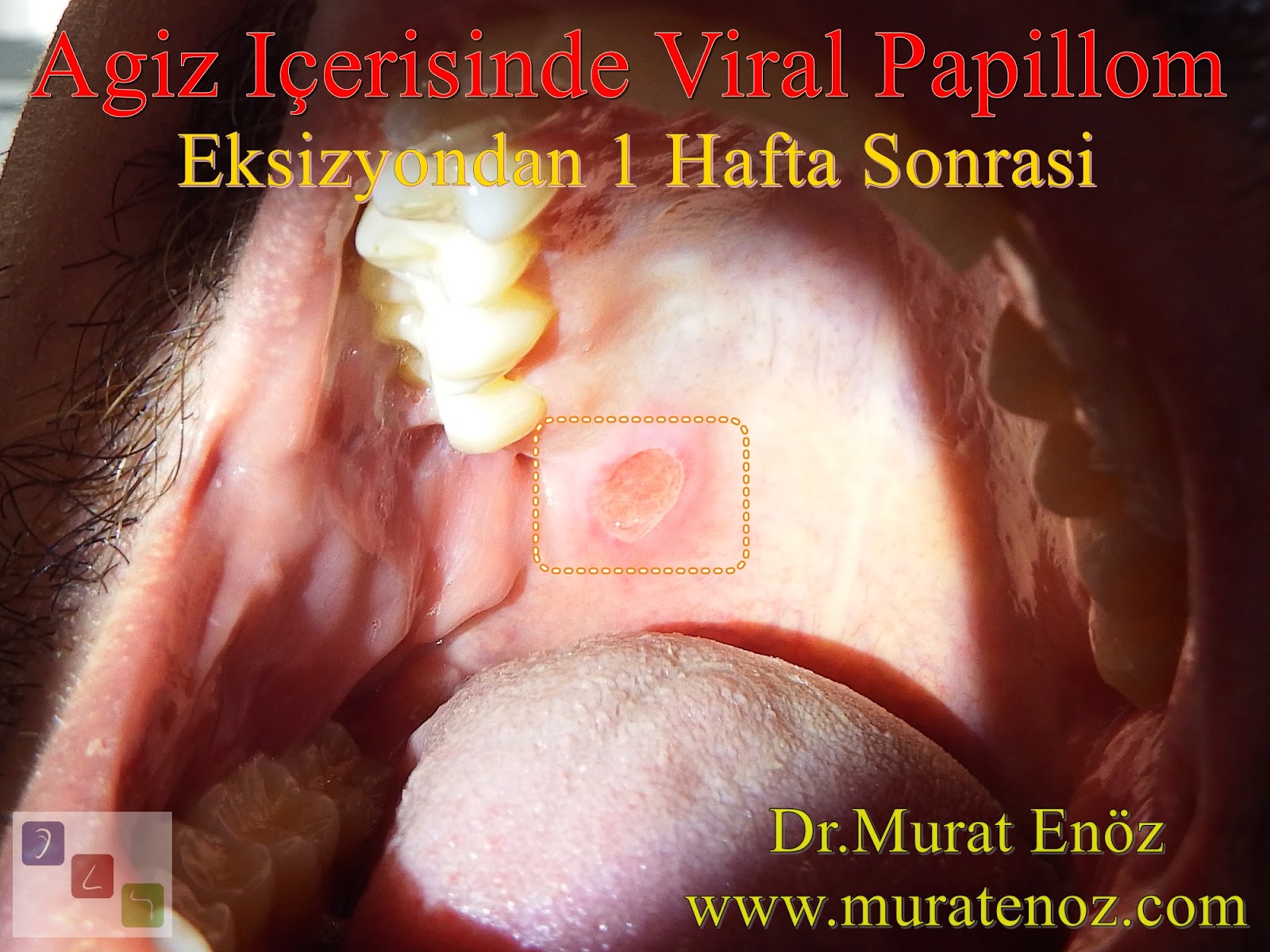 Oral Human Papillomavirus (HPV) Infection - Symptoms, Diagnosis ...