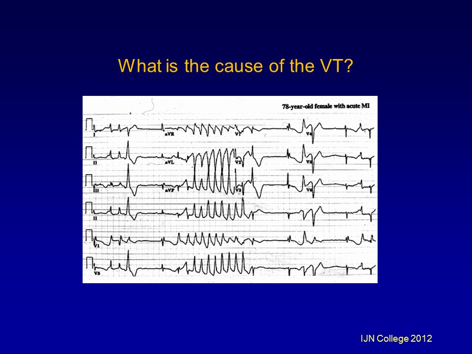 CVT Mohd Farid: Electrocardiogram Arrhythmia Part II-Credit Dr ...