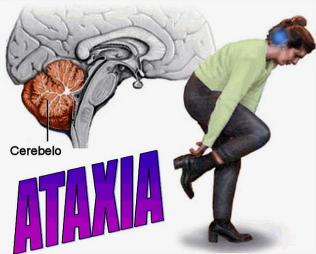 Ataxia: sintomas, causas e tratamento